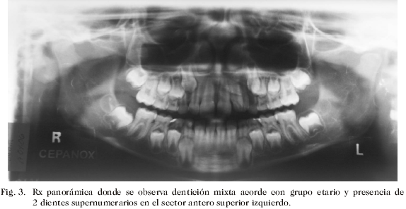 Aplicación de matriz de hueso humano desmineralizado en el ...