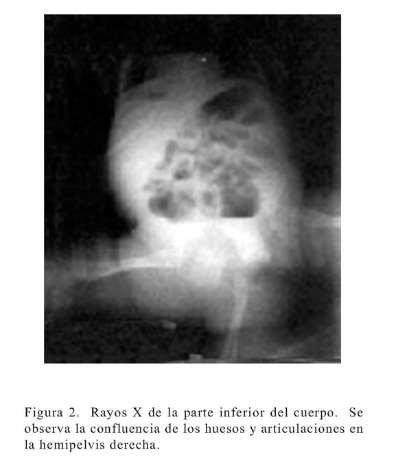 Dipygus: Reporte de un caso