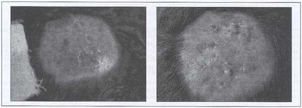 Querion de Celso ulcerado por Trichophyton mentagrophytes, var ...