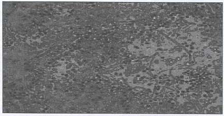 Querion de Celso ulcerado por Trichophyton mentagrophytes, var ...