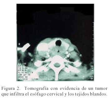 Cáncer De Hipofaringe