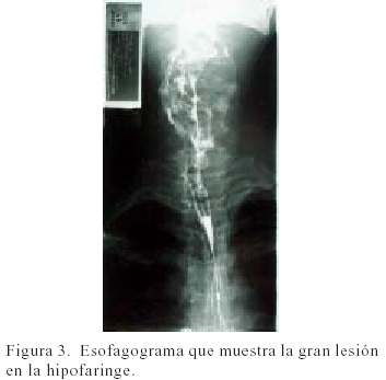 Cáncer De Hipofaringe