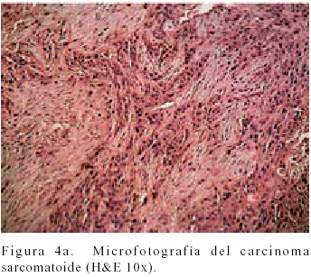 Carcinoma sarcomatoide de hipofaringe: Reporte de un caso