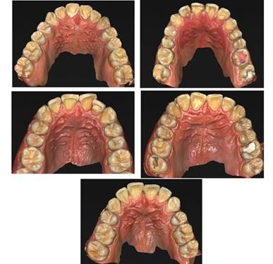 USO DE LA RUGOSCOPIA PALATINA EN ODONTOLOGÍA FORENSE SEGÚN ...
