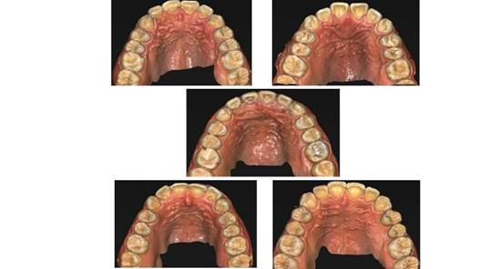 USO DE LA RUGOSCOPIA PALATINA EN ODONTOLOGÍA FORENSE SEGÚN ...