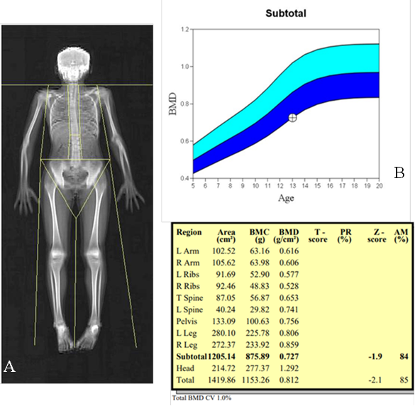 Osteopenia en una adolescente blanca hispana: reporte de caso
