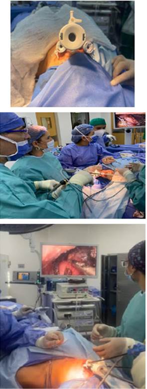 TOETVA (Tiroidectomía endoscópica transoral por abordaje vestibular) y ...