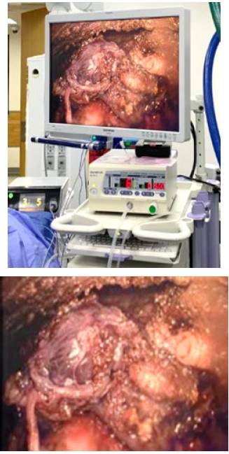 TOETVA (Tiroidectomía endoscópica transoral por abordaje vestibular) y ...