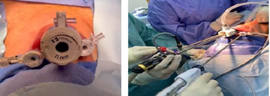 TOETVA (Tiroidectomía endoscópica transoral por abordaje vestibular) y ...