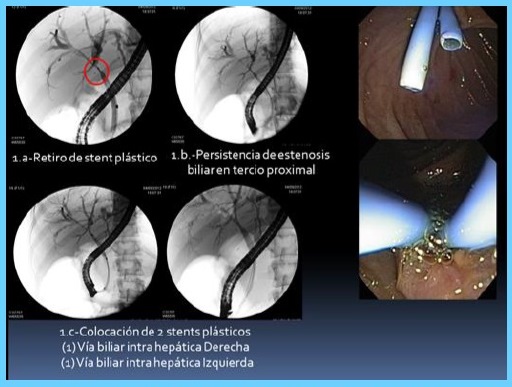 Tratamiento de rescate en estenosis biliar benigna postquirúrgica con ...