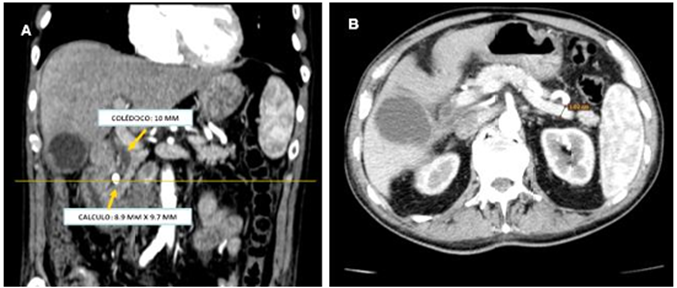 Pileflebitis como complicación de colangitis y colecistitis aguda