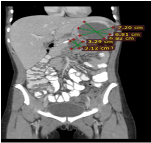 Pancreatitis Aguda y Lesión Ductal Pancreática Complicada con ...