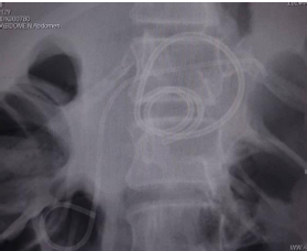 Pancreatitis Aguda y Lesión Ductal Pancreática Complicada con ...