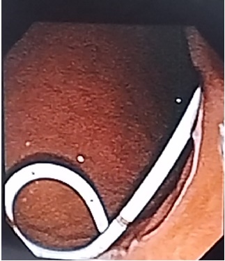 Drenaje endoscópico de los pseudoquistes de páncreas