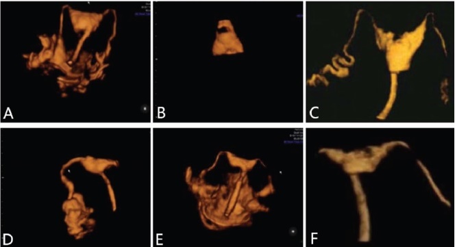 Clinical value of four-dimensional hysterosalpingo-contrast sonography ...
