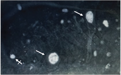 Nuclear and cytoplasmic expressions of the receptor for advanced ...