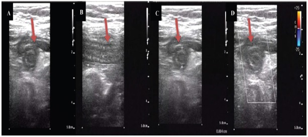 Diagnostic value of abdominal ultrasound in patients with acute ...