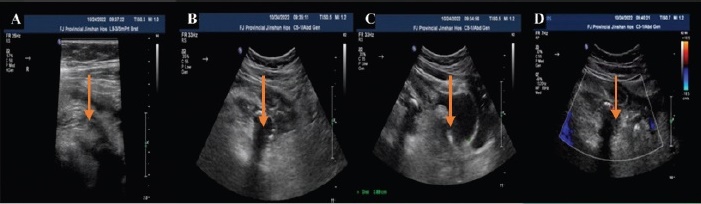 Diagnostic value of abdominal ultrasound in patients with acute ...
