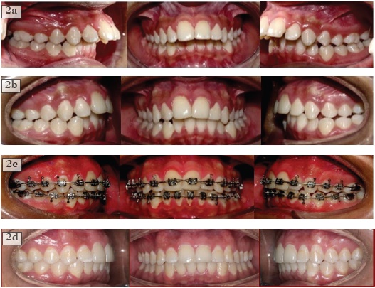 Prediction of the individual response to treatment of skeletal Class II ...