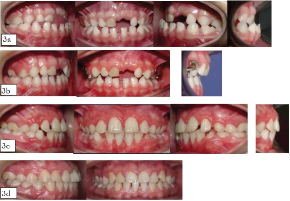 Prediction of the individual response to treatment of skeletal Class ...