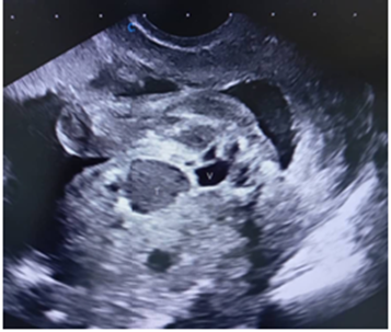 Duplicación quística intestinal, del diagnóstico ecográfico al quirúrgico