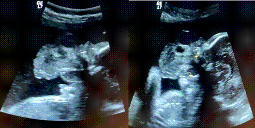 Tumor congénito de la cavidad oral: probable epignatus