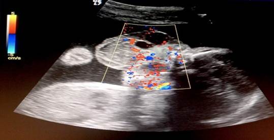 Tumor congénito de la cavidad oral: probable epignatus