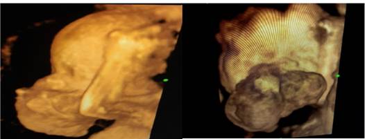 Tumor congénito de la cavidad oral: probable epignatus