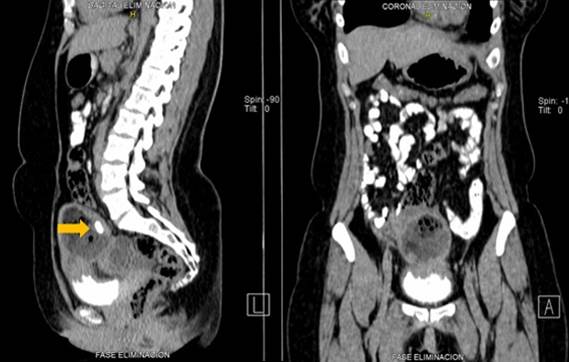 Teratoma quístico maduro con fistula vesical: una complicación excepcional