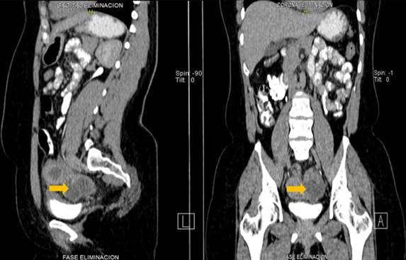 Teratoma quístico maduro con fistula vesical: una complicación excepcional