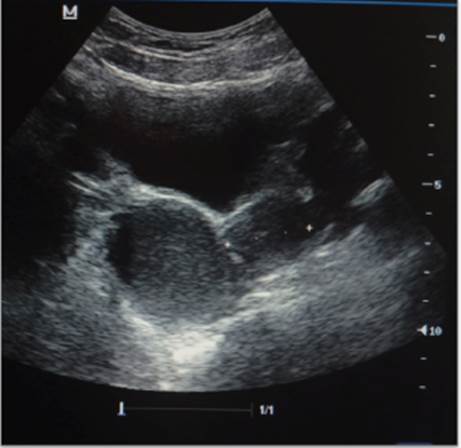 OHVIRA (hemivagina obstruida y anomalía renal ipsilateral): abordaje ...