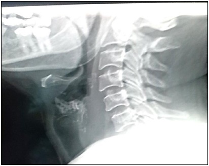 Trauma esofágico como complicación del uso de prótesis dentales en un ...