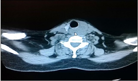 Trauma esofágico como complicación del uso de prótesis dentales en un ...