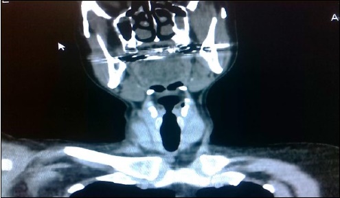 Trauma esofágico como complicación del uso de prótesis dentales en un ...