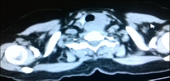 Trauma esofágico como complicación del uso de prótesis dentales en un ...