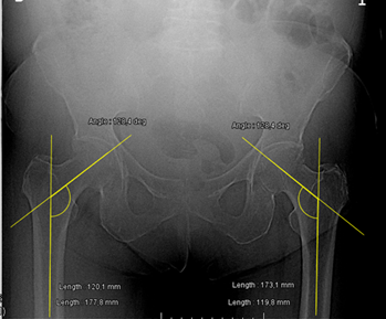 Medición radiológica del ángulo cérvico diafisario femoral en población ...