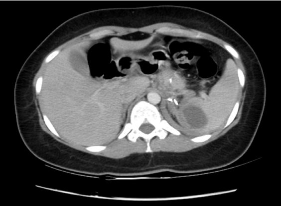 INFARTO ESPLÉNICO COMO COMPLICACIÓN DE GASTRECTOMÍA VERTICAL ...