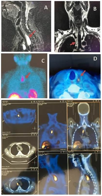 ADENOMA PARATIROIDEO MEDIASTÍNICO GIGANTE. ABORDAJE CERVICAL Y ...
