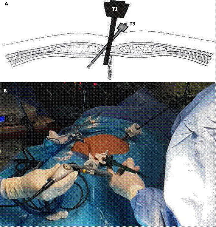 Colecistectomia Laparoscopica Colecistectomia Laparoscopica: Guida