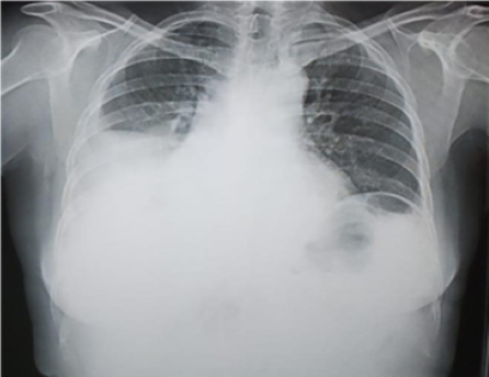 FÍSTULA PLEUROCUTÁNEA POR ENTEROCOCCUS DOS ENTIDADES POCO FRECUENTES ...