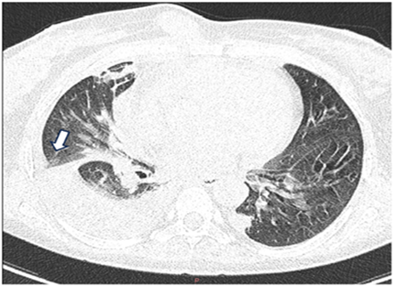 FÍSTULA PLEUROCUTÁNEA POR ENTEROCOCCUS DOS ENTIDADES POCO FRECUENTES ...