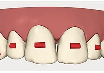 Tratamiento odontológico de Invisalign en pacientes adultos