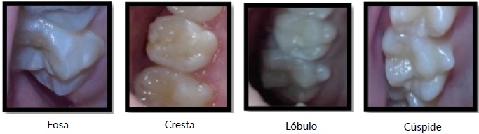 Prevalencia del tubérculo de Carabelli en una población infantil