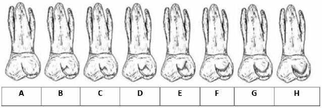 Prevalencia del tubérculo de Carabelli en una población infantil
