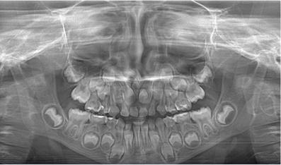 Intervención temprana de dientes supernumerarios en dentición primaria ...