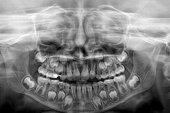 Intervención temprana de dientes supernumerarios en dentición primaria ...