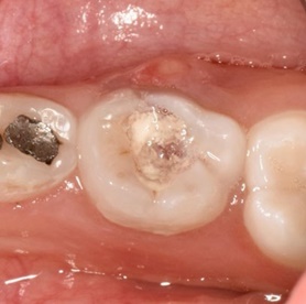 Técnica LSTR con pasta CTZ para el tratamiento de la necrosis pulpar en ...