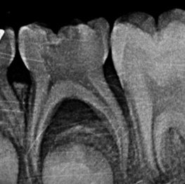 Técnica LSTR con pasta CTZ para el tratamiento de la necrosis pulpar en ...