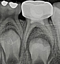 Técnica LSTR con pasta CTZ para el tratamiento de la necrosis pulpar en ...